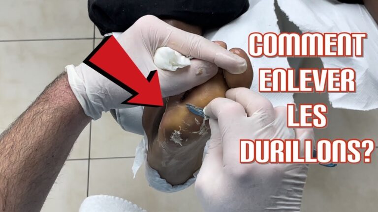 Comment enlever un durillon sous le pied efficacement